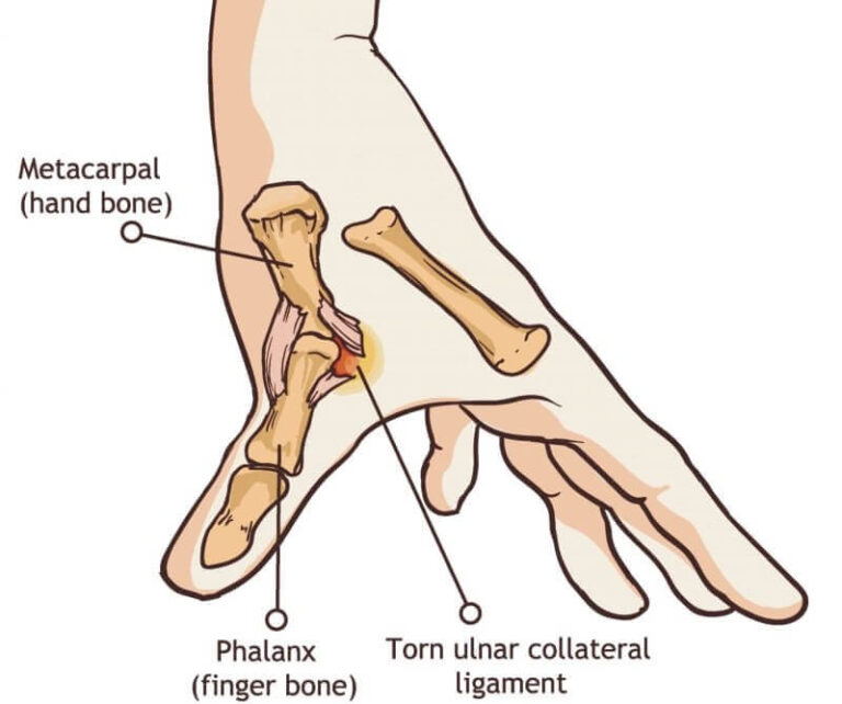 Skier's Thumb (UCL Injury): What you must know to avoid instability